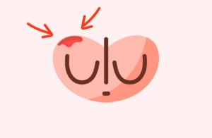 Angiome bébé : causes, symptômes, et traitements